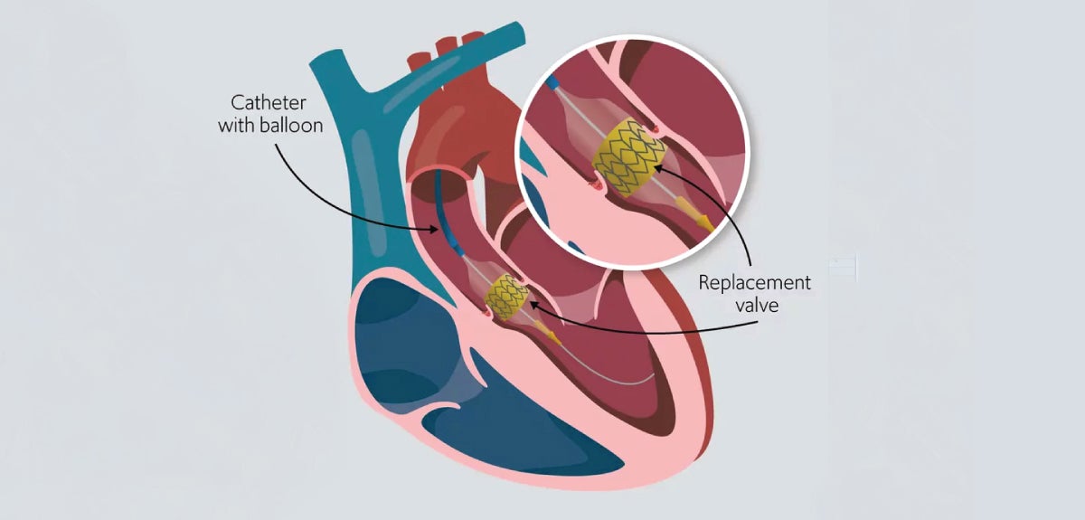 TAVR | Saint Agnes Medical Center